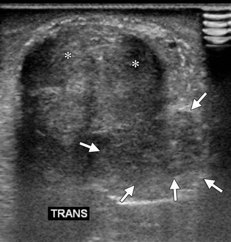 Imaging Of Penile And Scrotal Emergencies Radiographics