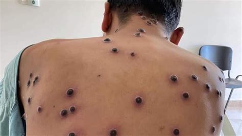 Mpox Oms Recuerda Que Se Cumple Un Año Del Inicio Del Brote De Viruela