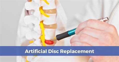 Artificial Disc Replacement Genesis Medical Plastics