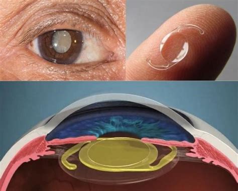 Facectomia por Facoemulsificação e Implante de Lio Cirurgia de