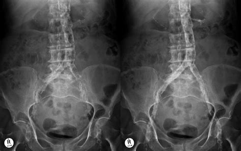 Abdominal Aortic Aneurysm Xray