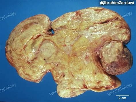 Liposarcoma Introduction