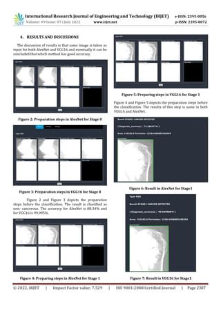 Bone Cancer Detection Using Alexnet And Vgg Pdf