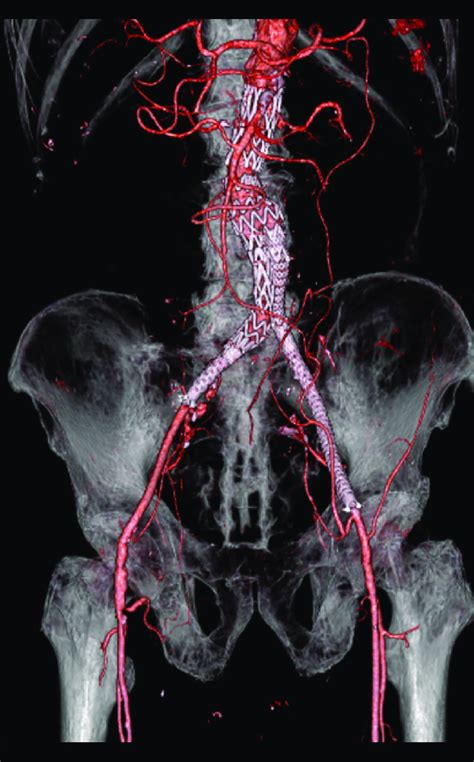 Postoperative Computed Tomography Angiography Image Shows No Endoleak