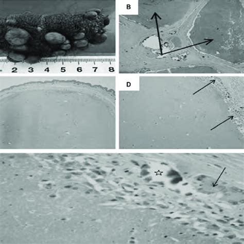 A Excised Skin Segment With Multiple Nodules Following Complete