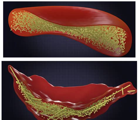 Sickle Cell Anemia Bad Luck And Simple Chemistry American Council On Science And Health