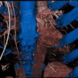 Coronary Mdct Angiography Coronal Color Coded Volume Renderings Of The