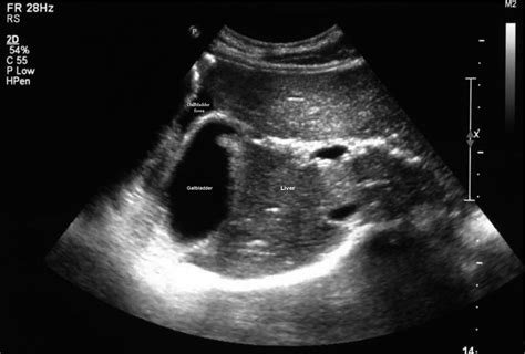 Ultrasound Appearance Of Gallbladder Volvulus Download Scientific Diagram