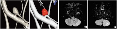 Thromboembolic Events Associated With Electrolytic Detachment Of Guglielmi Detachable Coils And