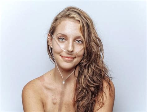 Has The Face Of Cystic Fibrosis Changed Forever