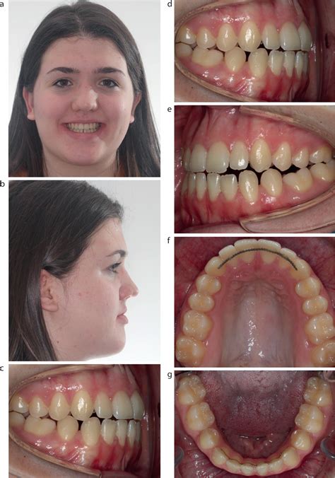 Orthodontic Update Root Resorption Why We All Need To Get Informed Consent