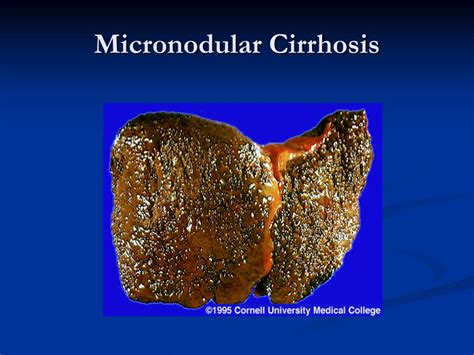 Ppt Cirrhosis Of Liver Powerpoint Presentation Free Download Id