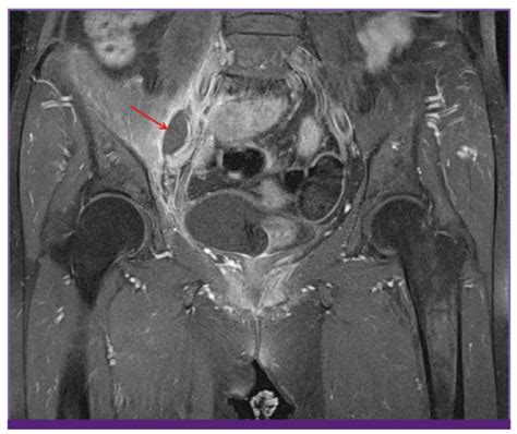 Contrast Enhanced T1 Weighted Magnetic Resonance Imaging Of Both Hips