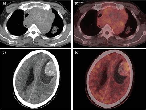 Thoracic Malignancies Radiology Key