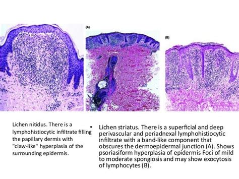 Interface Dermatitis Tutorial
