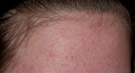 Sandpaper Rash On Trunk At Jo Diggs Blog