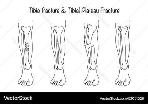 Tibia Fracture Royalty Free Vector Image Vectorstock