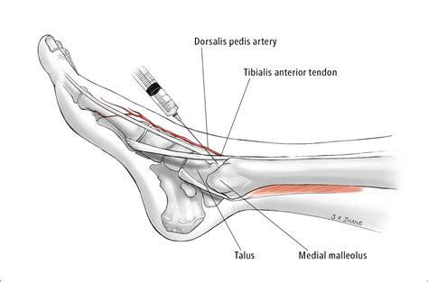 Knee Arthrocentesis Landmarks
