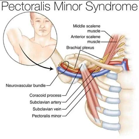 Maak 🚨 Pectoralis Minor Syndrome What You Need To Facebook
