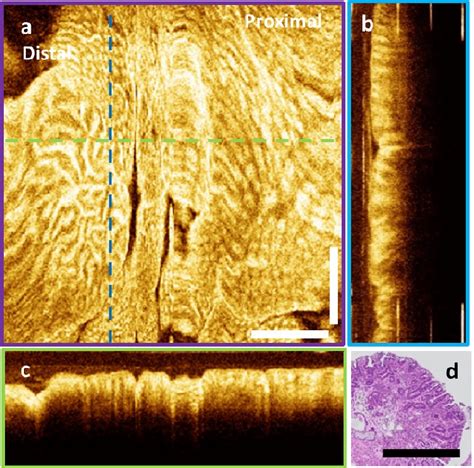 Volumetric Oct Data Set Of Barretts Esophagus With High Grade Download Scientific Diagram