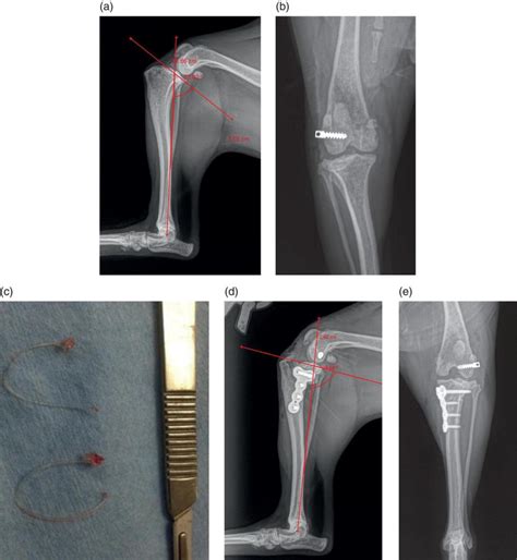 Complications Associated With Extracapsular Stabilization Using