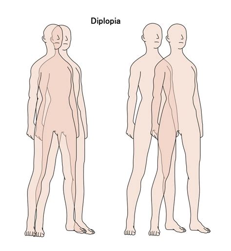 Diplopia Binocular Que Es At Michael Mullett Blog