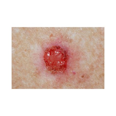 What Is A Small Squamous Cell Carcinoma