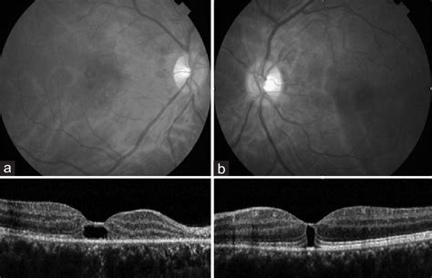 A Fundus Photograph Of The Od Showing A Macular Cyst B Fundus