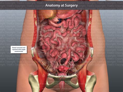 Bowel Resection And Anastomosis