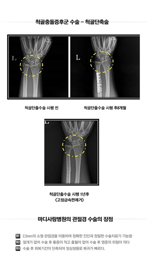 마디사랑병원 질환별 소개 손목 척골충돌증후군