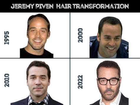 Trasplante De Cabello Jeremy Piven