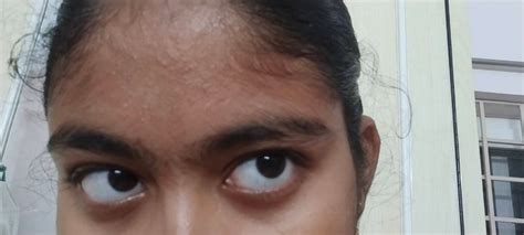 Dermdoc Ultra Dew Sunscreen Stick