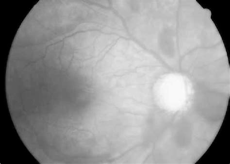 Figure 1 From Three Types Of Retinal Bleeding As A Complication Of Hypotony Aftertra Beculectomy