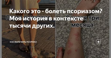 Какого это болеть псориазом Моя история в контексте тысячи других