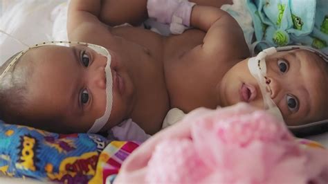 Conjoined Twins Successfully Separated At North Texas Hospital