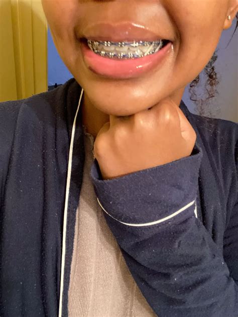 Navy Blue Braces Braces Tips Cute Braces Cute Braces Colors
