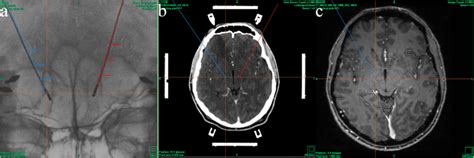Co Registration Of Intraoperative Stereotactic X Ray Image A With Download Scientific Diagram