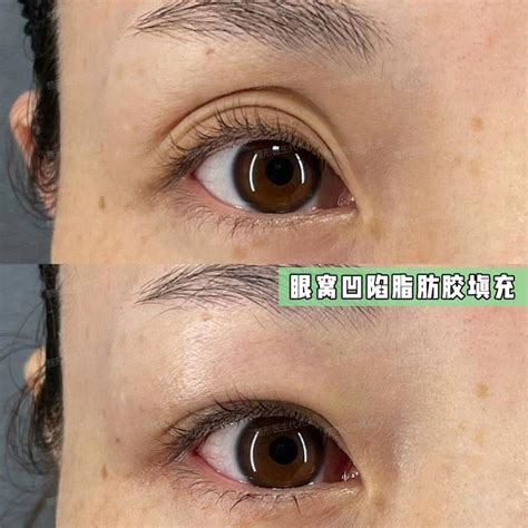 做眼窝凹陷脂肪胶填充，求美者问的最多的十个问题 知乎