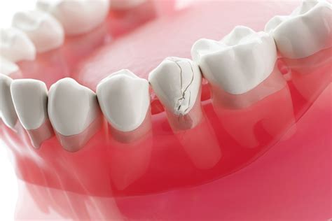 Symptoms Causes And Treatments For Cracked Teeth Phoenix Endodontists