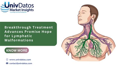 Breakthrough Treatment Advances In Lymphatic Malformations A Beacon Of