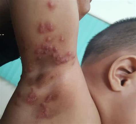 An Overview Of Scabies MicroBiotics