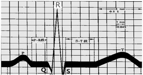 Electrocardiogram Waveform Classification Method And Device Eureka