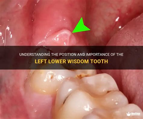 Understanding The Position And Importance Of The Left Lower Wisdom