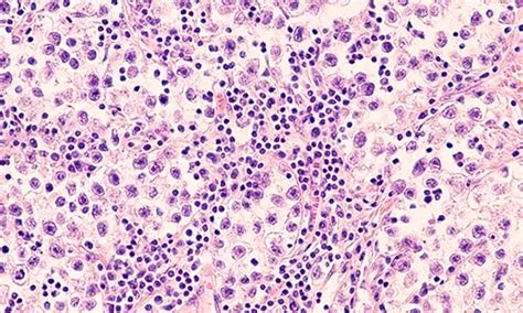 Testicular Cancer Symptoms Diagnosis Treatment And Support Moc