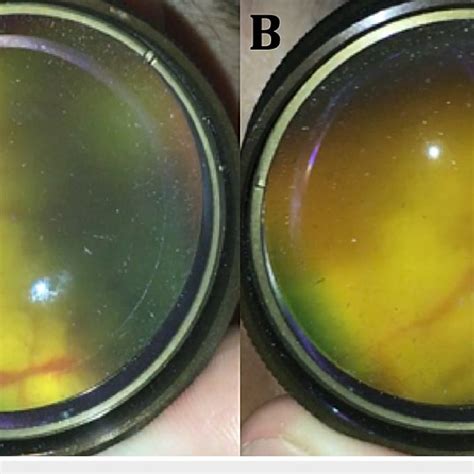 Fundoscopy Demonstrating Resolution Of Acute Retinal Necrosis
