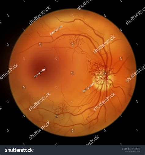 Proliferative Diabetic Retinopathy Illustration Showing