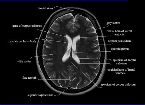 Normal Brain Ct Anatomy