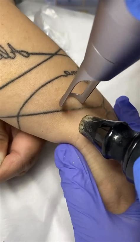 Understanding The Healing Process After Laser Tattoo Removal
