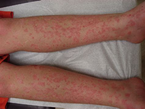 Severely Pruritic Plaque Psoriasis On Lower Extremities Before