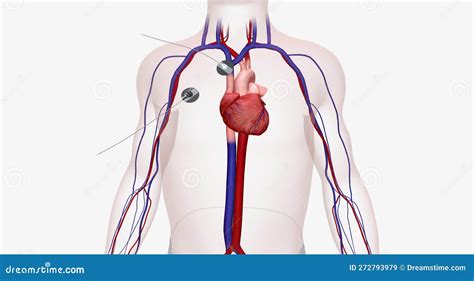 Electrode And Electrical Patch Placement Stock Illustration Illustration Of Disease Cardiac